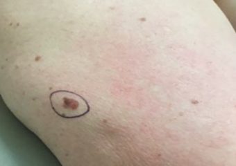 Understanding Skin checks and skin cancer: A vital guide for ...
